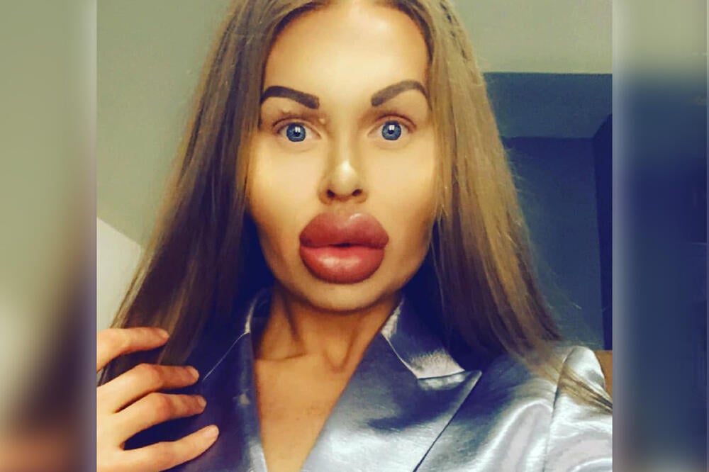 Се навлекол на пластични операции па почнал сам да си се боцка СТРАШНО